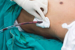 Best ICD Insertion in Kukatpally | Dr. Sunil Lung Care Center